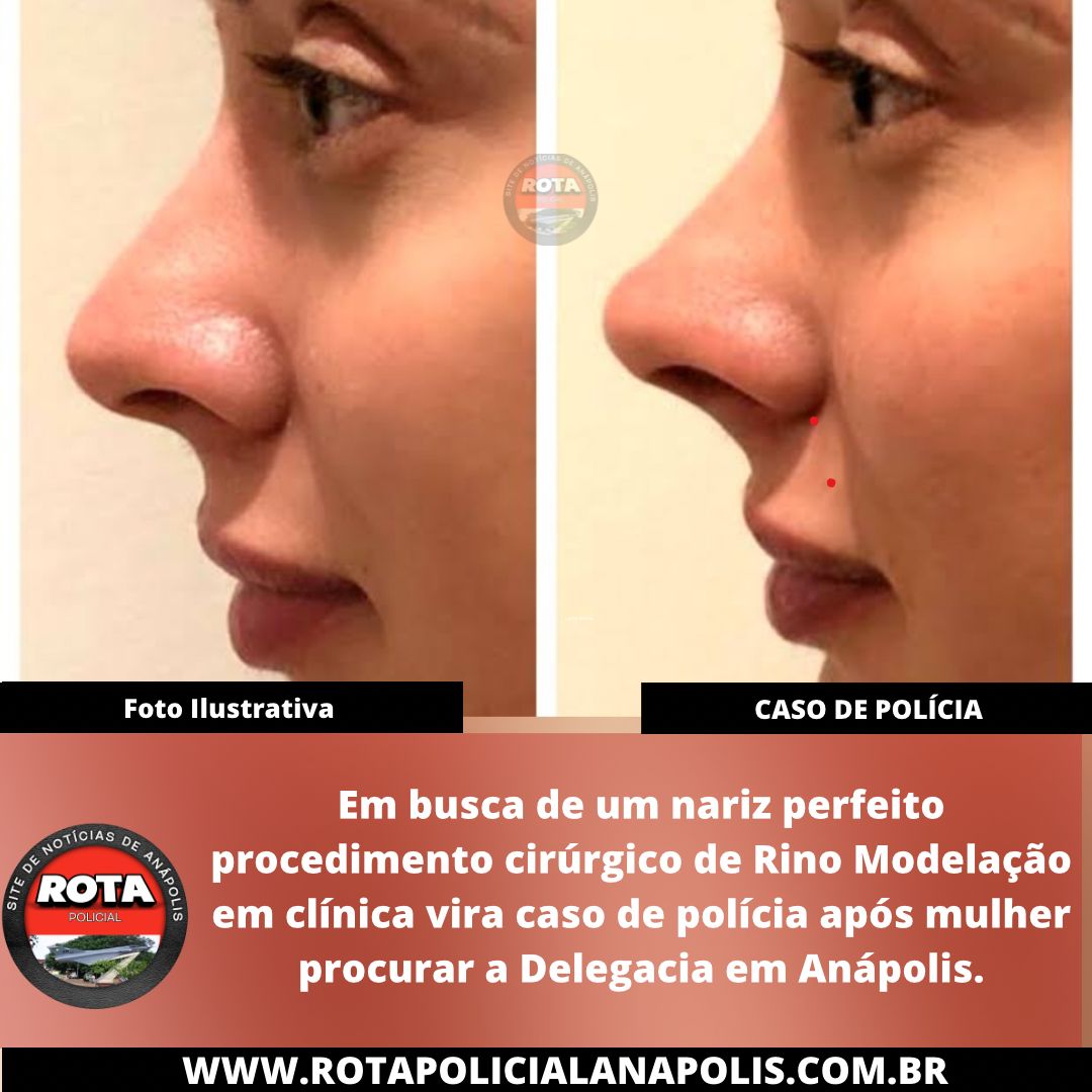 Em busca de um nariz perfeito procedimento cirúrgico de Rino Modelação ...